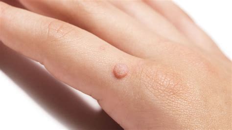Hpv Flat Warts On Face