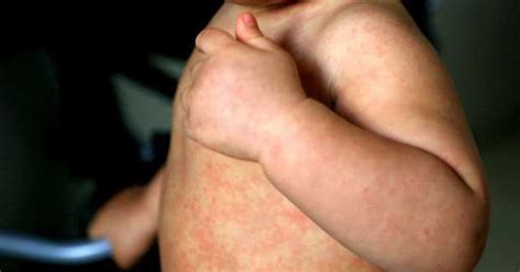 Brote De Sarampión En El Amba Hay Más De Diez Casos Confirmados Y
