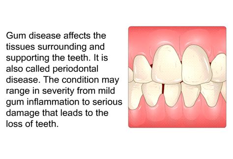PatEdu Com Gum Disease