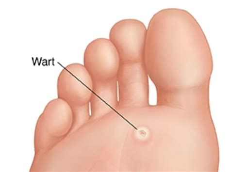 Verruca Plantaris Cause The Royal College Of Podiatry