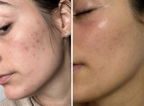 Glowup™ Led Light Therapy Face Mask Groomie Hers