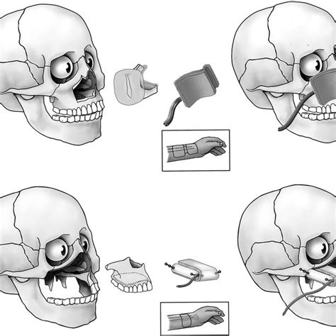 Pdf A Classification System And Algorithm For Reconstruction Of Maxillectomy And Midfacial Defects