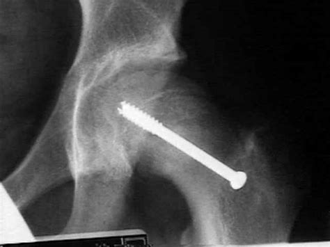 Treatment Scfe Wheeless Textbook Of Orthopaedics