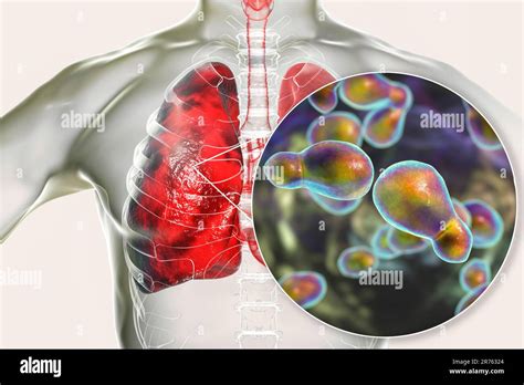 Pulmonary Cryptococcosis Invasion Of A Lung Tissue By Yeast Fungi