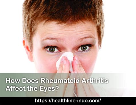 Arthritis Causing Eye Problems At Andrea Mcclelland Blog