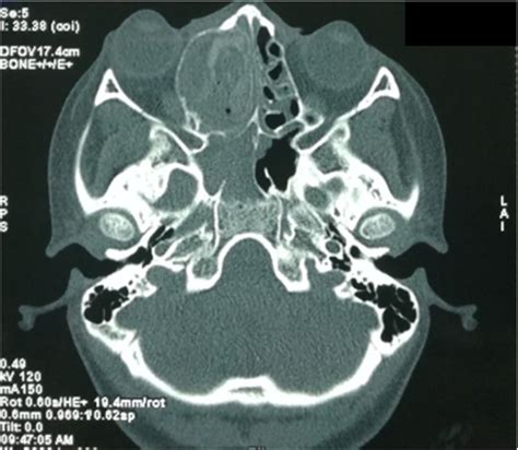 Axial Ct Scan Showing Ossifying Fibroma Arising In The Right Nasal