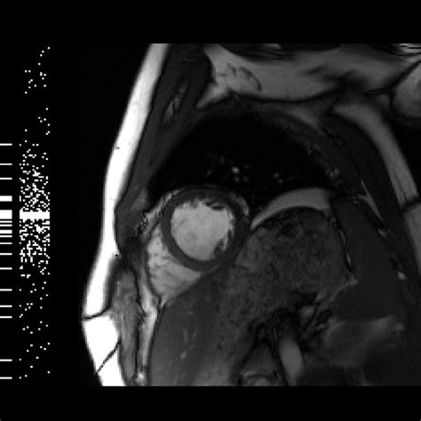 the gaussian variable density undersampling mask used in this work at