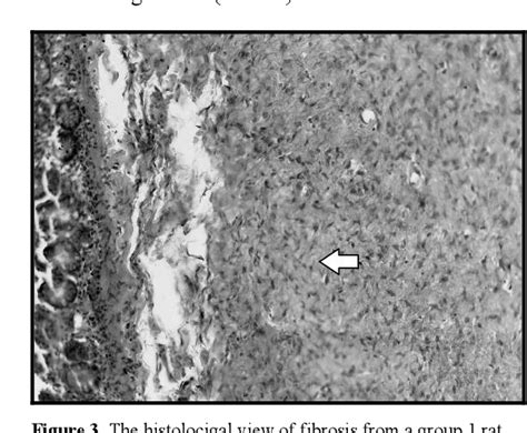 Figure 1 From Comparison Of 4 Icodextrin And Auto Crosslinked