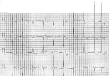 Pediatric Hypertrophic Cardiomyopathy Workup Approach Considerations