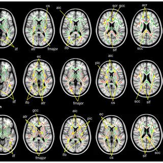 PDF Tract Specific Analyses Of Diffusion Tensor Imaging Show Widespread White Matter