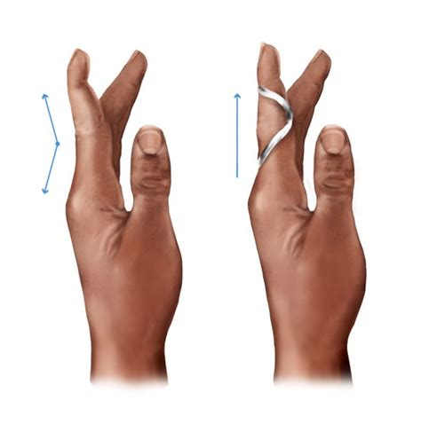 Ring Splints For Ehlers Danlos Syndrome Hypermobility Spectrum Disorders The Ehlers Danlos