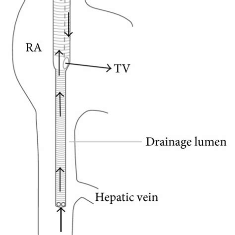 Cannulation Options In Vv Ecmo A Femorojugular Configuration B Download Scientific