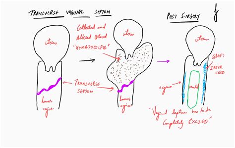 Transverse Vaginal Septum IVF Endometriosis Clinic In Mumbai
