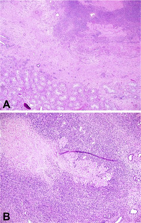 Corpus Albicans Slide