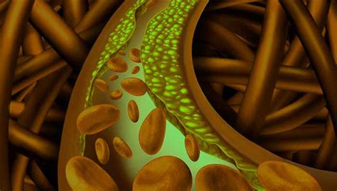 Atherosclerosis The Silent Killer Of Your Arteries Revealed