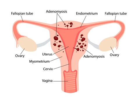 Endometriosis And Adenomyosis Symptoms Diagnosis Treatment Pantai