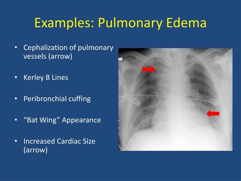Cephalization Definition Chest X Ray At Frank Jobe Blog