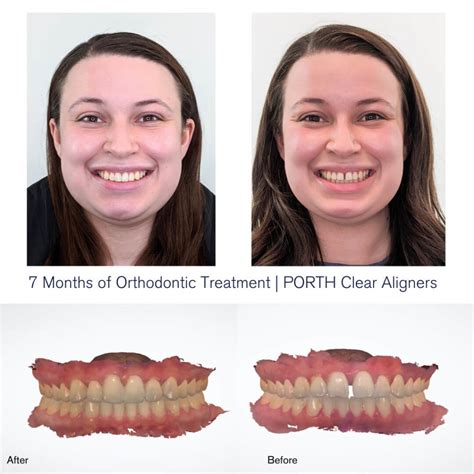 Invisalign Before And After Severe Crowding