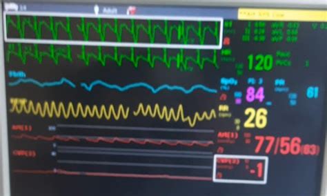 Fetal Complete Heart Block A Successful Surgical Permanent Pacemaker