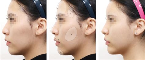 필러 페이스 컨투어링 필러 Page Lab Clinic 페이지랩 안티에이징 전문 클리닉
