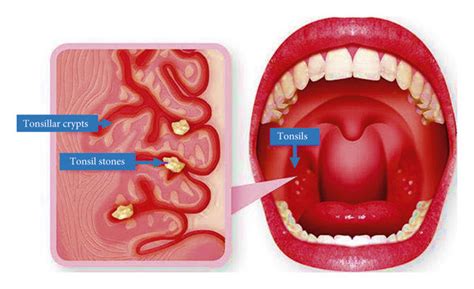 Tonsil Stones Diagram What Are Tonsil Stones 😟 Tonsil Stones