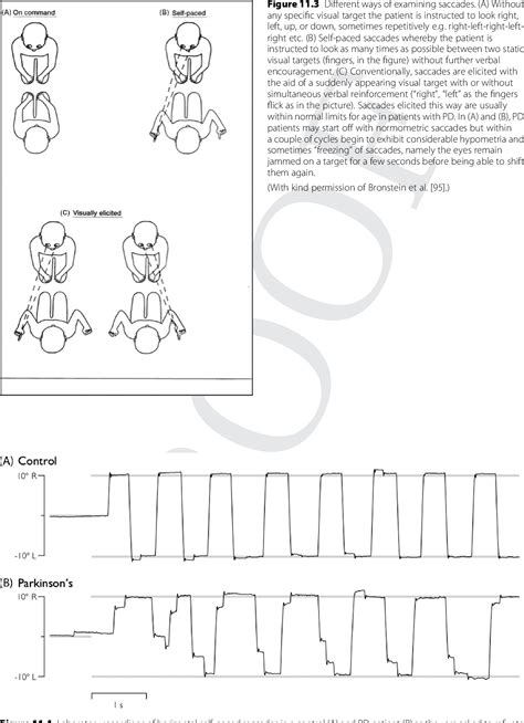 Figure 11 3 From 11 Oculomotor And Visuo Vestibular Function In Parkinson S Disease Semantic