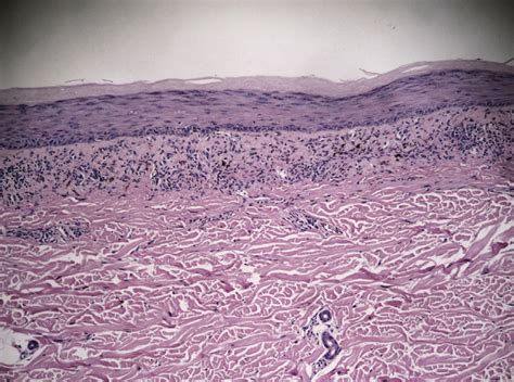 Biopsy Specimen From The Left Inguinal Skin Lesion Showing Atrophic