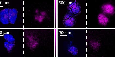 Tiny Sensor Aims To Monitor Tumors In Real Time Ieee Spectrum