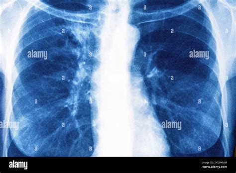 Right And Left Lung Cancer Stage 1 Front Chest X Ray Lung Cancer