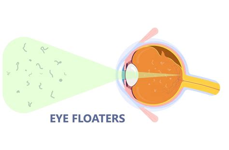 What Doctor Do I See For Eye Floaters Downtown Eye Care And The