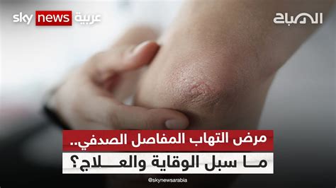 مرض التهاب المفاصل الصدفي ما سبل الوقاية والعلاج؟ الصباح Youtube
