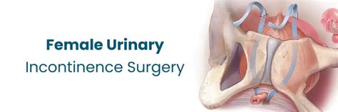 Bladder Sling Surgery