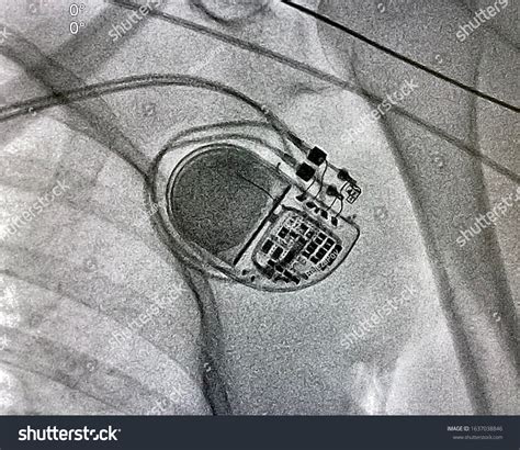 Artificial Pacemaker Stock Photos Images Photography Shutterstock