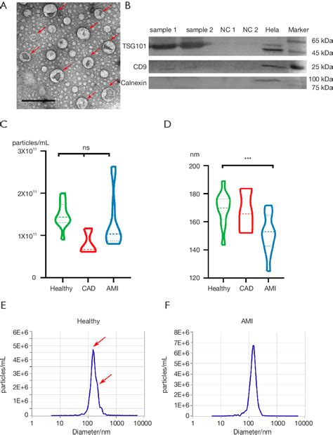Figure 1 From Evaluation Of Exosomal Mirnas As Potential Diagnostic Biomarkers For Acute