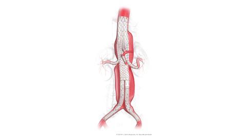 Bassett Medical Center Performs Networks First Tambe® Procedure To