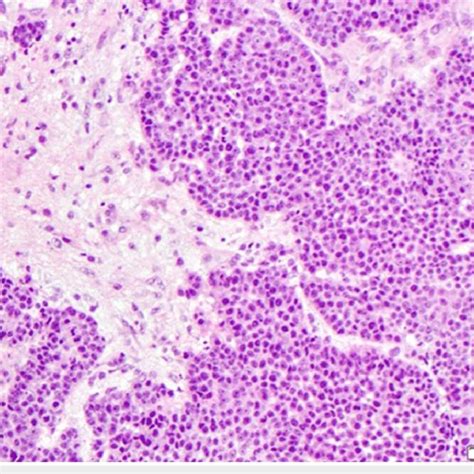 Surgical Pathology Of Intracranial Lesion The Left Area Shows What