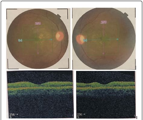 The Macular Oct Showing Exudates In The Plexiform Layer Of The Left Retina Download
