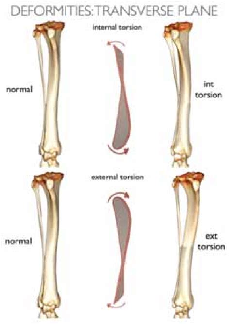 Tibial Internal Rotation