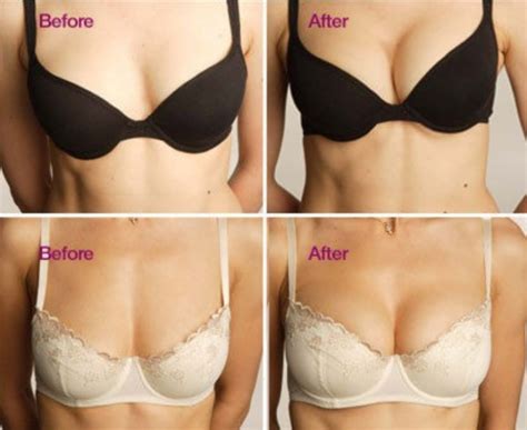 Hyaluronic Acid Breast Augmentation Injection Filler Breast