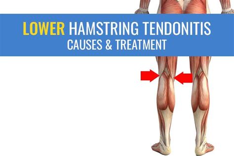 Hamstring Tendonitis Artofit