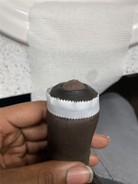 Day Number 6 Of Using Prepex Like Device R Selfcircumcision