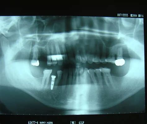 Quest Ce Quun Implant Dentaire Clinique Dentaire Mont Blanc