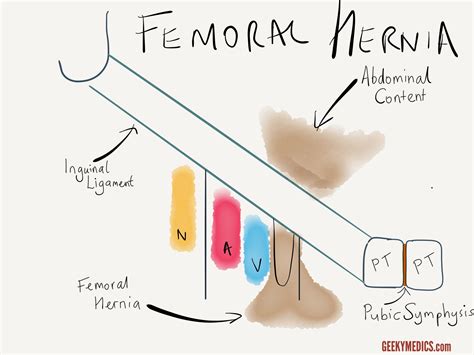 Femoral Hernia Vs Inguinal Hernia Images And Photos Finder