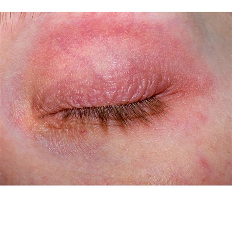 5 Key Causes And Solutions For Eye Dermatitis Eczema Around The Eyes