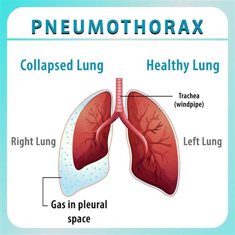 Pneumothorax Diagram With Collapsed Lung And Healthy Lung 3356811