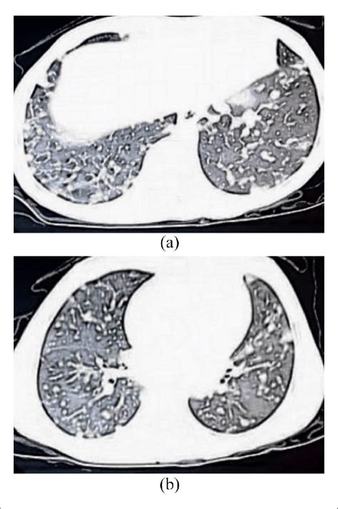 Multiple Pulmonary Nodules In Both Lungs Download Scientific Diagram