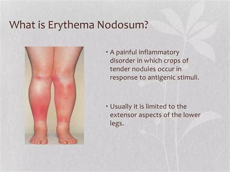 Erythema Nodosum Pdf