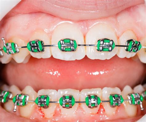Conventional Braces Vs Self Ligating Smile Craft Dental Clinic Puchong