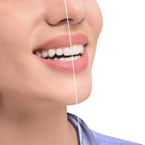 Gingivectomy In Riyadh Jeddah Saudi Arabia Enfield Royal Saudia