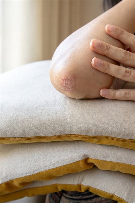 Close Up Of A Person Touching A Red Dry Patch Of Skin On Their Elbow